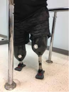 How Physical Therapy Helped an Amputee Recover - PRO~PT